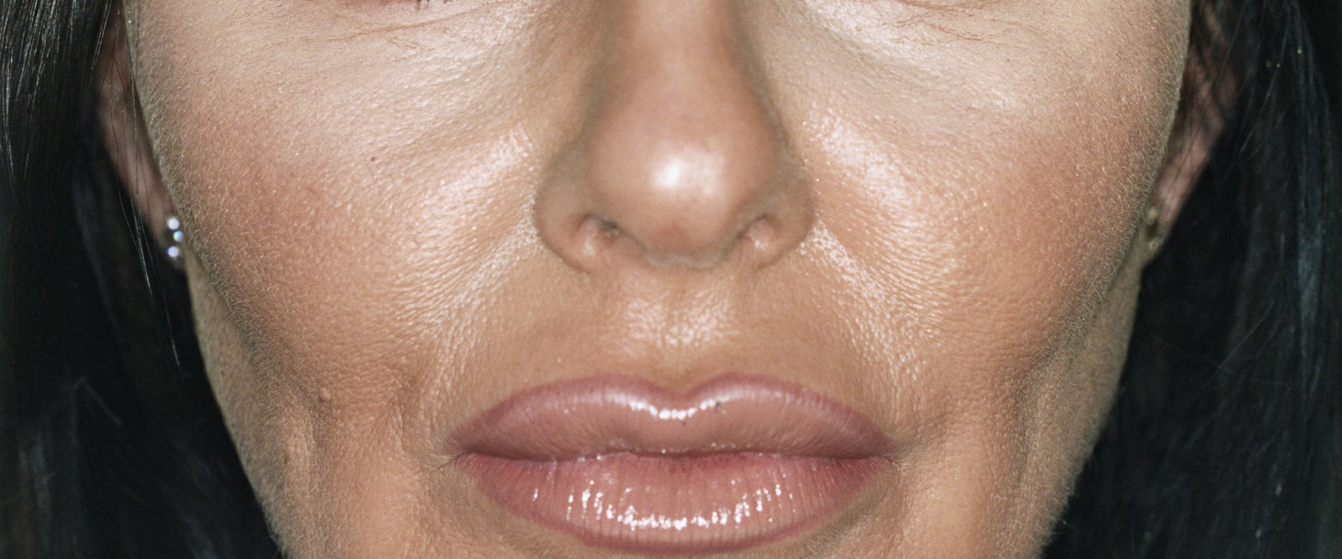 The Benefits of Botox: How It Can Change Your Face