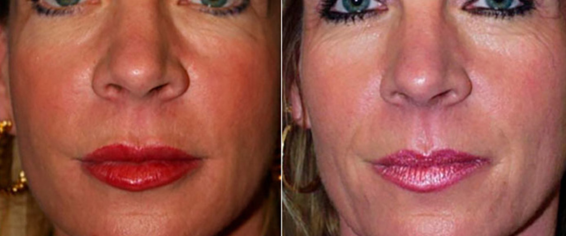 What Happens if Botox is Injected into a Vein?