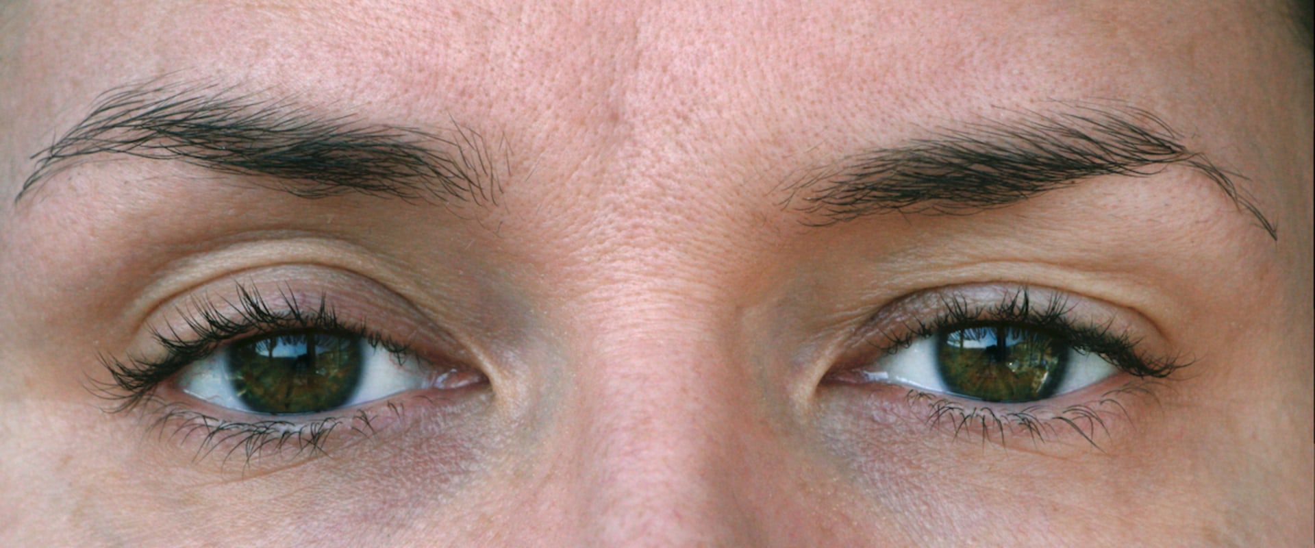 The Long-Term Effects of Botox: Is It Safe to Use Over Time?